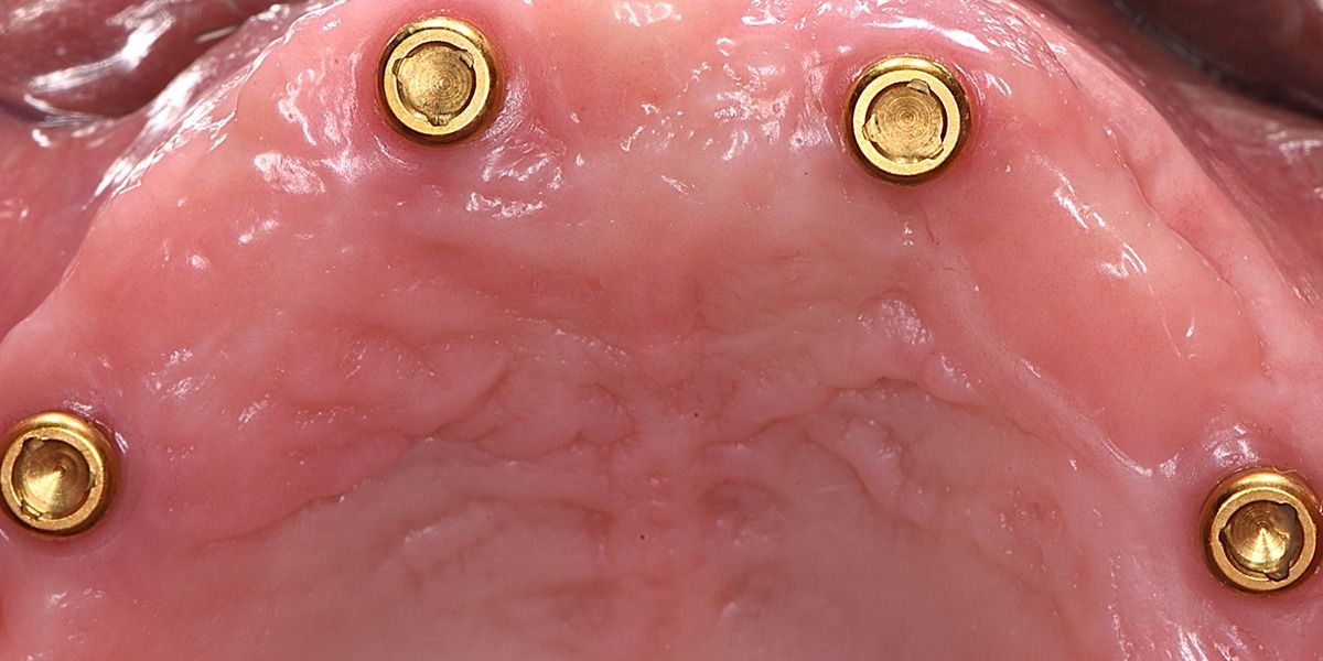 Simultaneous Maxillary Guided Bone Regeneration with Implant Placement, Using a Layered ...